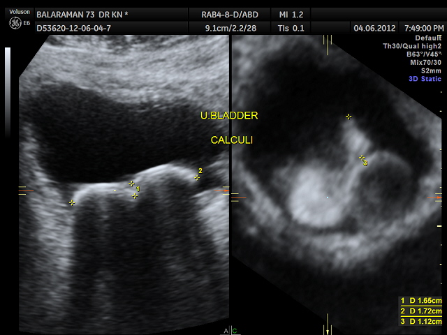 VESICAL CALCULI | Looking Through a Transducer