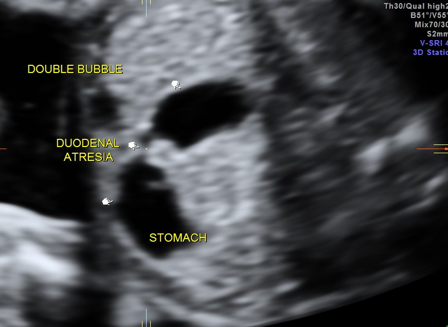 DUODENAL ATRESIA | Looking Through a Transducer