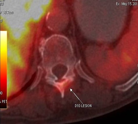 LIVER SECONDARIES – A CASE REPORT | Looking Through a Transducer