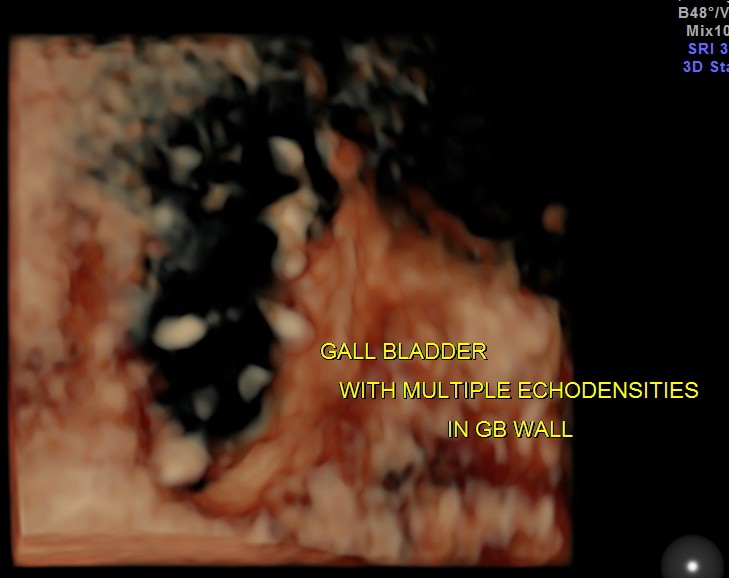 CHOLESTEROLOSIS OF THE GALLBLADDER- STRAWBERRY GALL BLADDER | Looking ...