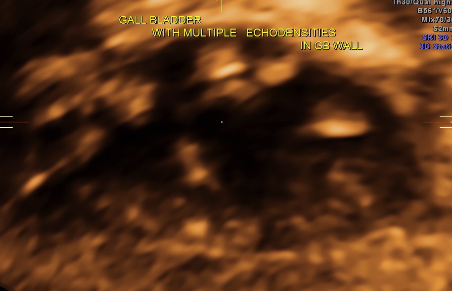 CHOLESTEROLOSIS OF THE GALLBLADDER- STRAWBERRY GALL BLADDER | Looking ...