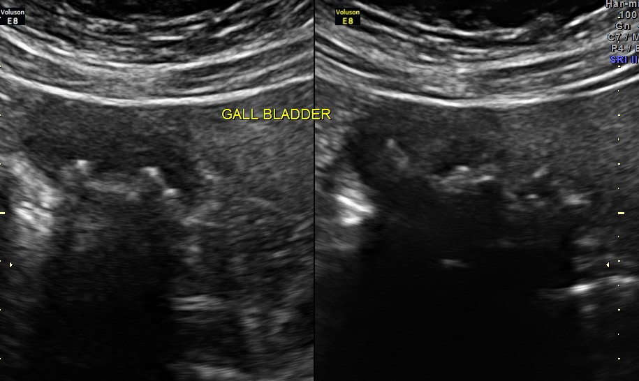 CHOLESTEROLOSIS OF THE GALLBLADDER- STRAWBERRY GALL BLADDER | Looking ...