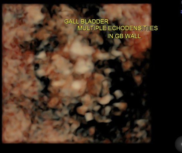 CHOLESTEROLOSIS OF THE GALLBLADDER- STRAWBERRY GALL BLADDER | Looking ...