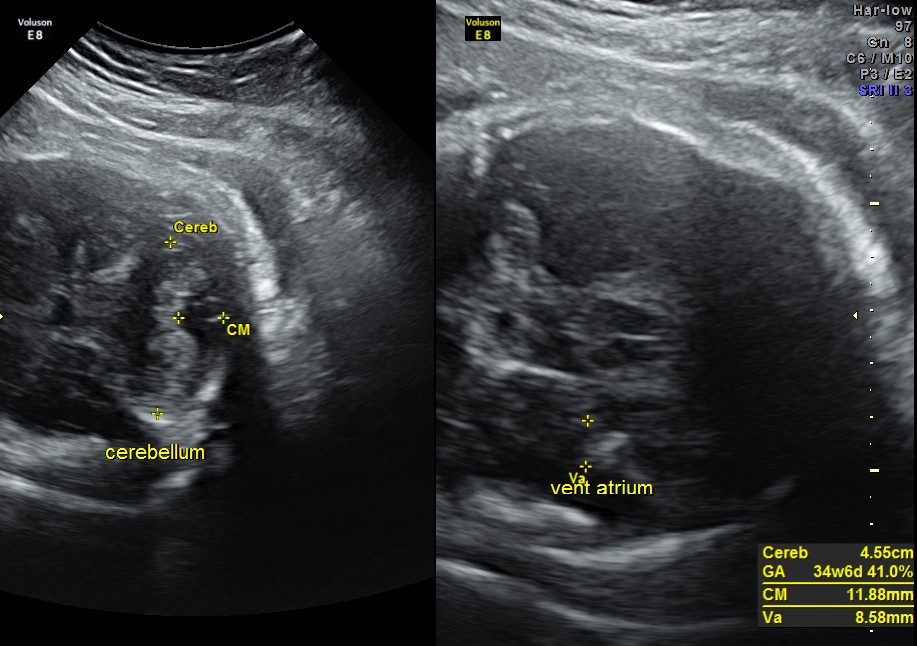 MEGA CISTERNA MAGNA | Looking Through a Transducer
