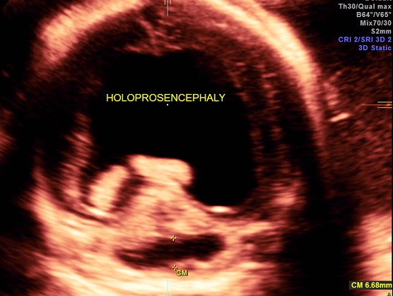 HOLOPROSENCEPHALY- ALOBAR | Looking Through a Transducer