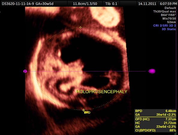 HOLOPROSENCEPHALY- ALOBAR | Looking Through a Transducer