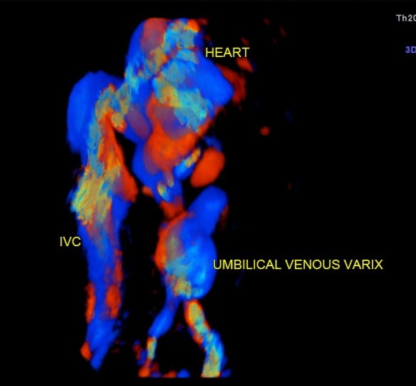 Fetal Umbilical Vein Varix | Looking Through a Transducer