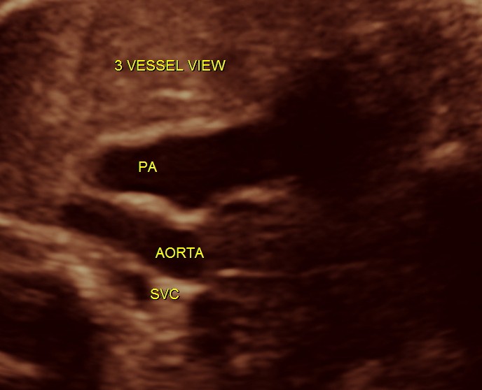 Fetal Umbilical Vein Varix | Looking Through a Transducer