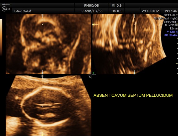 SPINA BIFIDA -OPEN NEURAL TUBE DEFECT 3D IMAGES | Looking Through a ...