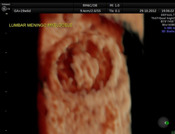 SPINA BIFIDA -OPEN NEURAL TUBE DEFECT 3D IMAGES | Looking Through a ...