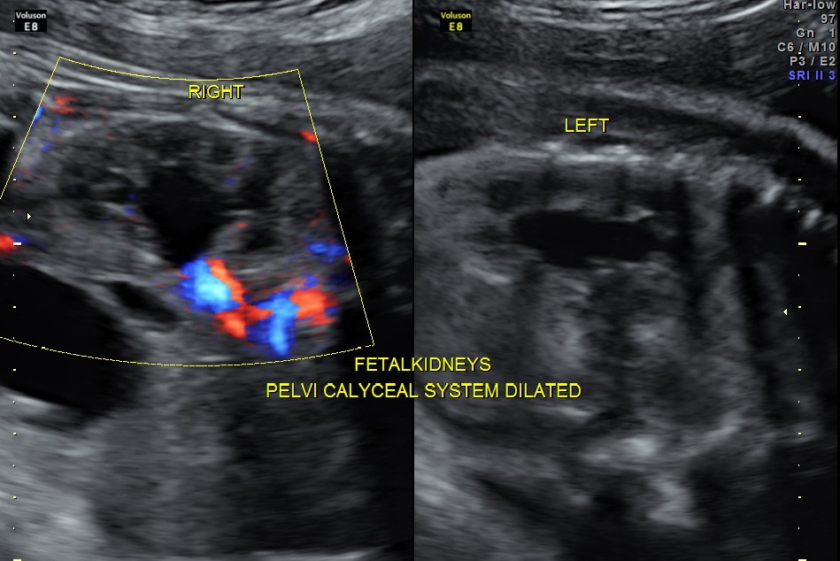 Congenital Diaphragmatic Hernia ( CDH ) and Fetal Hydronephrosis ...
