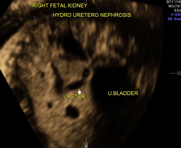 Congenital Diaphragmatic Hernia ( CDH ) and Fetal Hydronephrosis ...