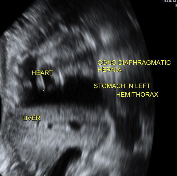 Congenital Diaphragmatic Hernia ( CDH ) and Fetal Hydronephrosis ...
