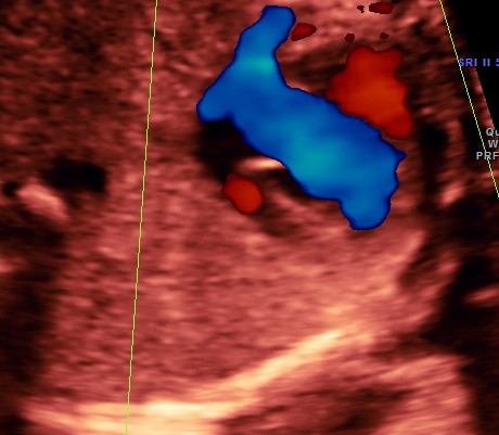 Hypoplastic Left Heart Syndrome (H.L.H.S.) | Looking Through a Transducer