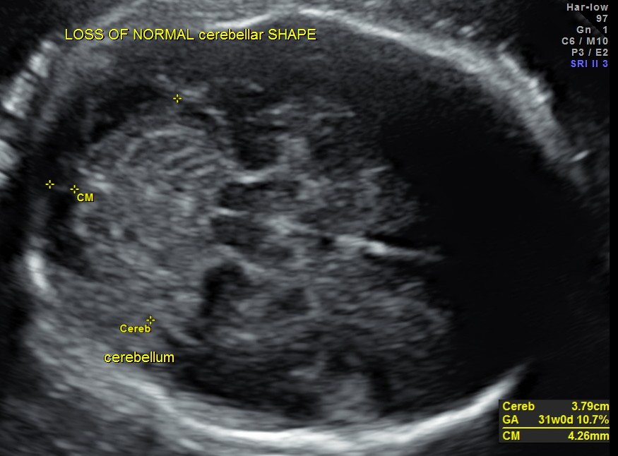 MENINGO MYELOCELE – 3 D & 4 D IMAGES | Looking Through a Transducer