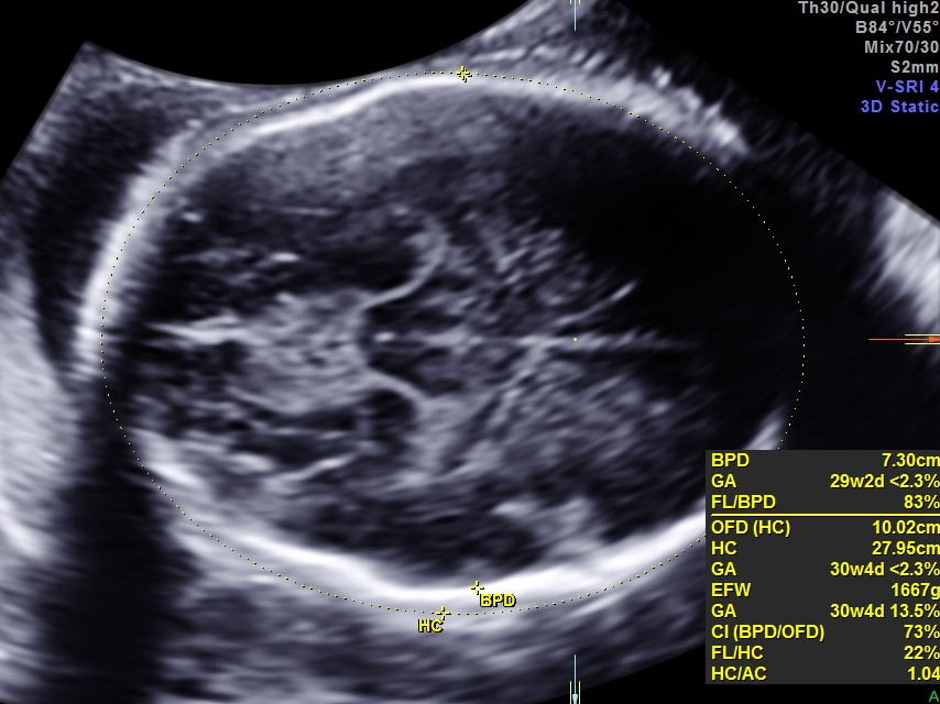 MENINGO MYELOCELE – 3 D & 4 D IMAGES | Looking Through a Transducer