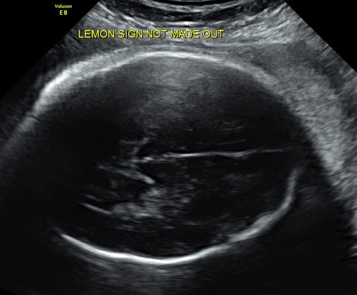 MENINGO MYELOCELE – 3 D & 4 D IMAGES | Looking Through a Transducer