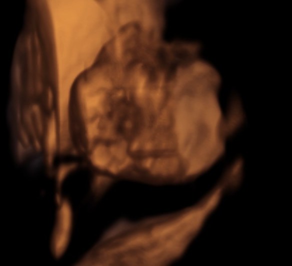 MENINGO MYELOCELE – 3 D & 4 D IMAGES | Looking Through a Transducer