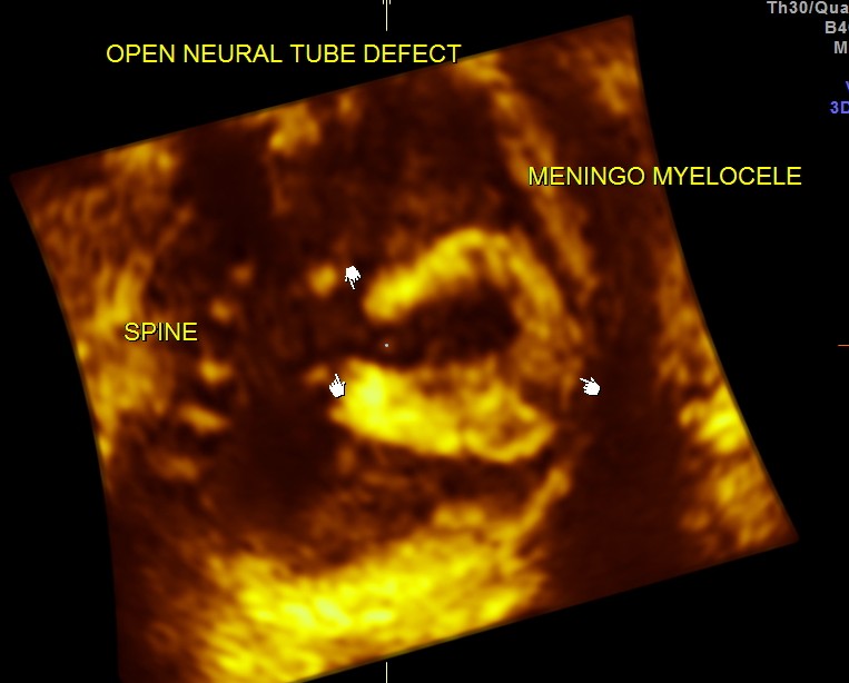 MENINGO MYELOCELE – 3 D & 4 D IMAGES | Looking Through a Transducer