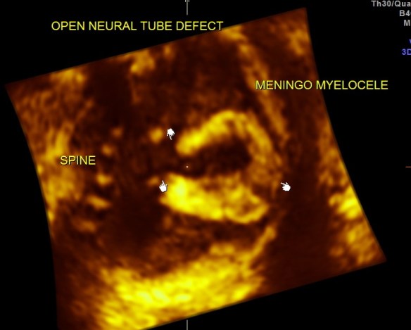 MENINGO MYELOCELE – 3 D & 4 D IMAGES | Looking Through a Transducer