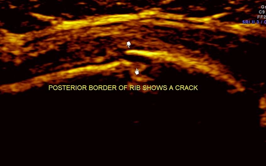 RIB FRACTURE ( picked up only by ultrasound) | Looking Through a Transducer