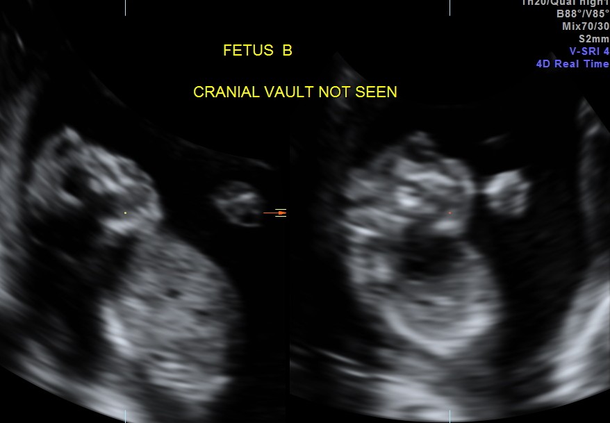 Mono chorionic , di amniotic twin pregnancy with anencephaly of one ...