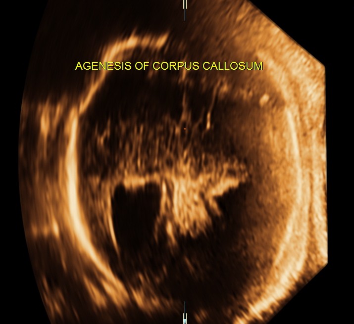 Agenesis of Corpus Callosum | Looking Through a Transducer