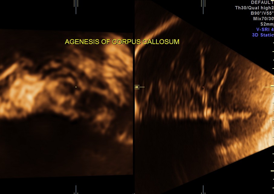 Agenesis of Corpus Callosum | Looking Through a Transducer