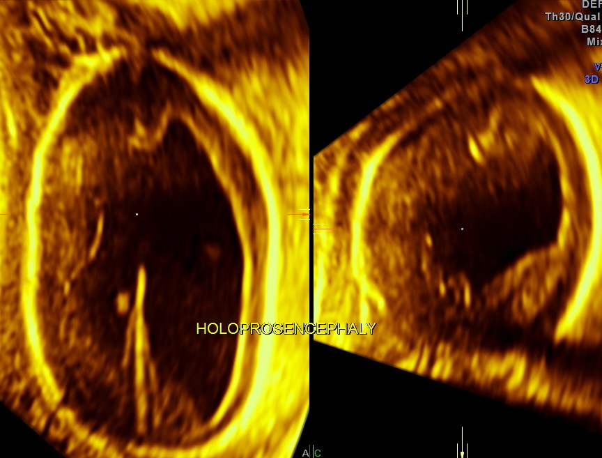 Holoprosencephaly,Right Atrial Isomerism,Coarctation of Aorta,Neural ...