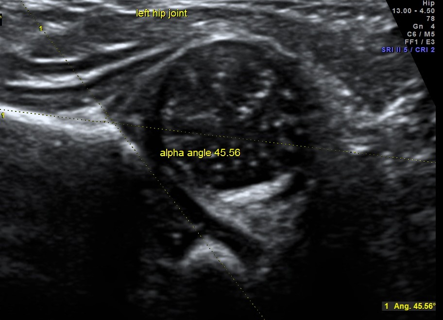 Developmental Dysplasia of HIP (D.D.H.) | Looking Through a Transducer