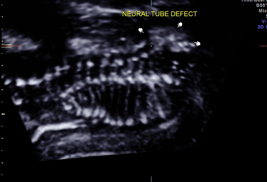Holoprosencephaly,Right Atrial Isomerism,Coarctation of Aorta,Neural ...
