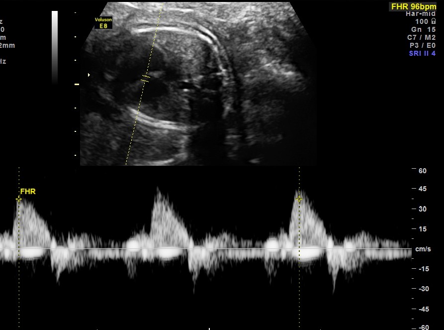 LEFT ATRIAL ISOMERISM , SITUS AMBIGUUS (or AMBIGUOUS), HETEROTAXY ...