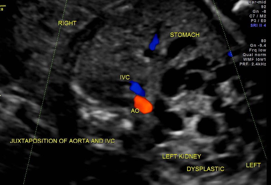 LEFT ATRIAL ISOMERISM , SITUS AMBIGUUS (or AMBIGUOUS), HETEROTAXY ...