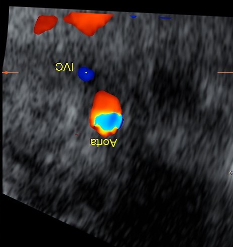 LEFT ATRIAL ISOMERISM , SITUS AMBIGUUS (or AMBIGUOUS), HETEROTAXY ...