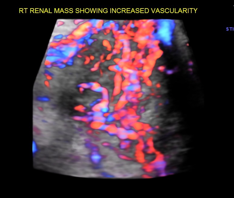 Adult Renal Mass – Colour Doppler and 3D Images | Looking Through a ...