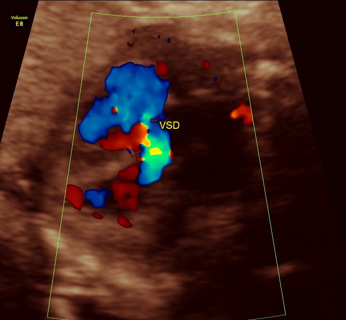Tetralogy Of Fallot ( TOF ) | Looking Through a Transducer