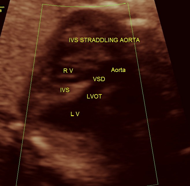 Tetralogy Of Fallot ( TOF ) | Looking Through a Transducer