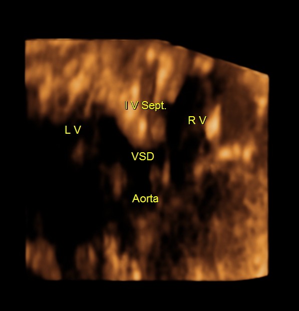 Tetralogy Of Fallot ( TOF ) | Looking Through a Transducer