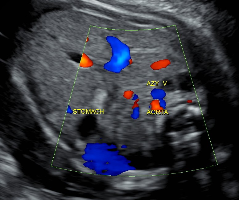 Tetralogy Of Fallot ( TOF ) | Looking Through a Transducer