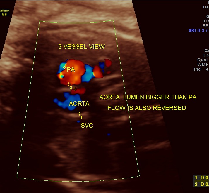 Tetralogy Of Fallot ( TOF ) | Looking Through a Transducer