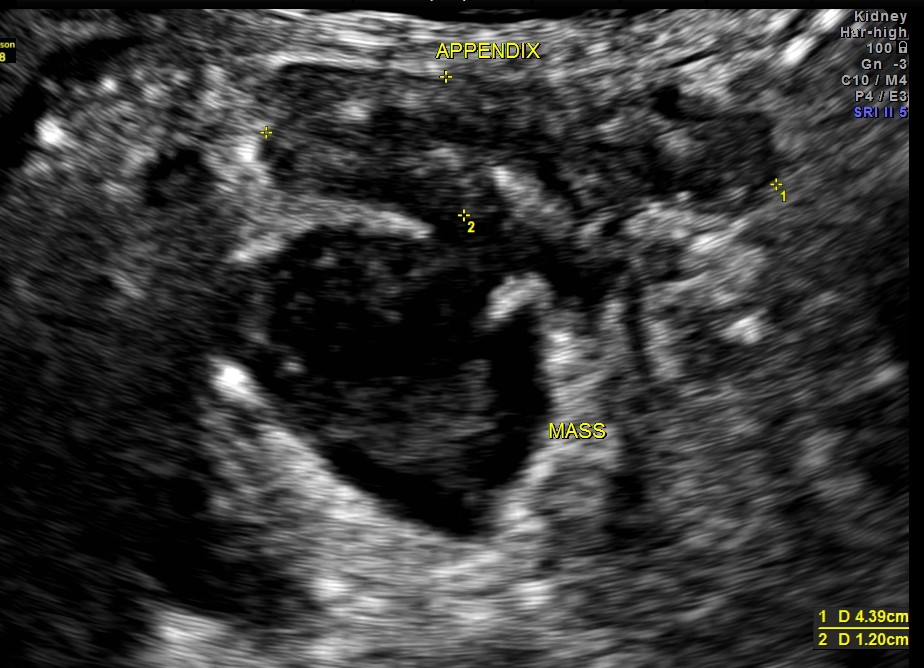 Appendicular mass | Looking Through a Transducer
