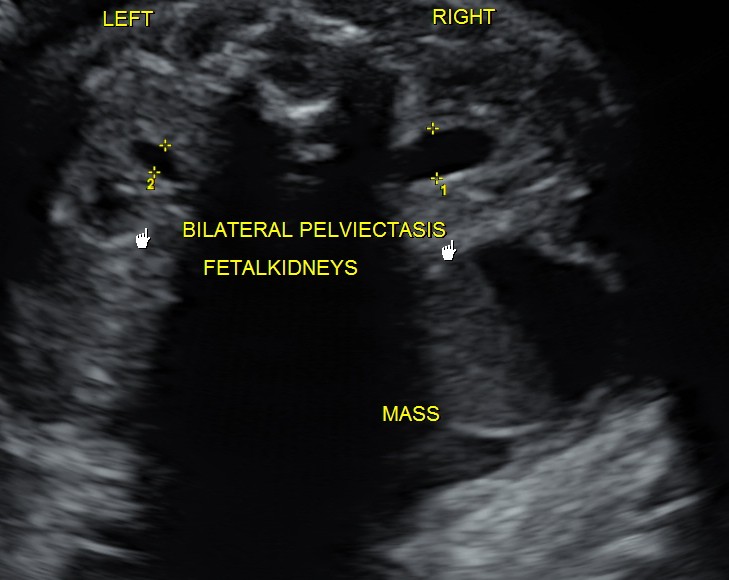FETAL ABDOMINAL MASS – ? OVARIAN CYST | Looking Through a Transducer