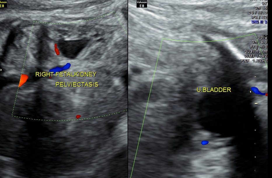 FETAL ABDOMINAL MASS – ? OVARIAN CYST | Looking Through a Transducer