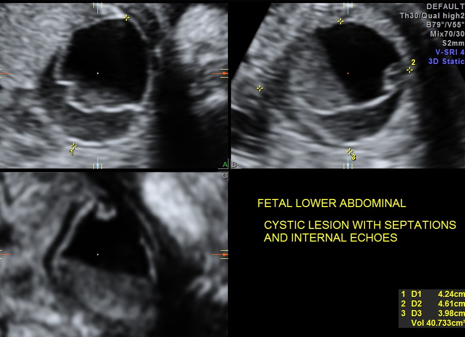 FETAL ABDOMINAL MASS – ? OVARIAN CYST | Looking Through a Transducer