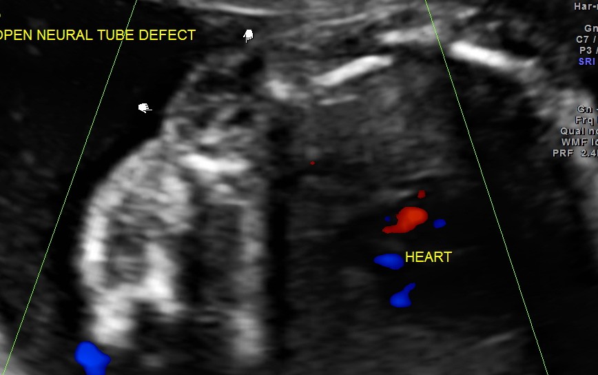 HYDROCEPHALUS , OPEN NEURAL TUBE DEFECT | Looking Through a Transducer