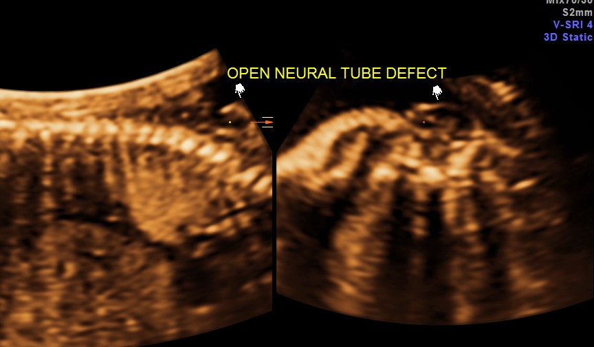 HYDROCEPHALUS , OPEN NEURAL TUBE DEFECT | Looking Through a Transducer