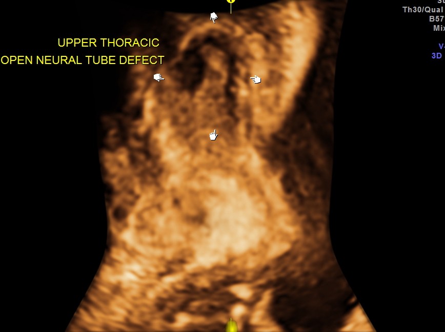 HYDROCEPHALUS , OPEN NEURAL TUBE DEFECT | Looking Through a Transducer