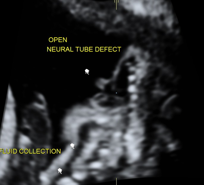HYDROCEPHALUS , OPEN NEURAL TUBE DEFECT | Looking Through a Transducer