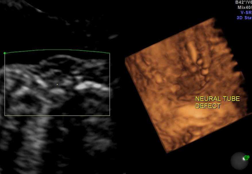 HYDROCEPHALUS , OPEN NEURAL TUBE DEFECT | Looking Through a Transducer
