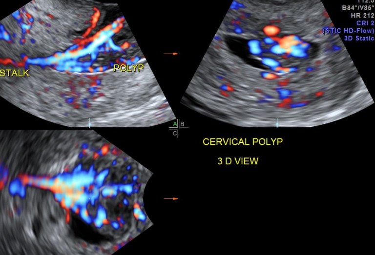 Cervical polyp | Looking Through a Transducer